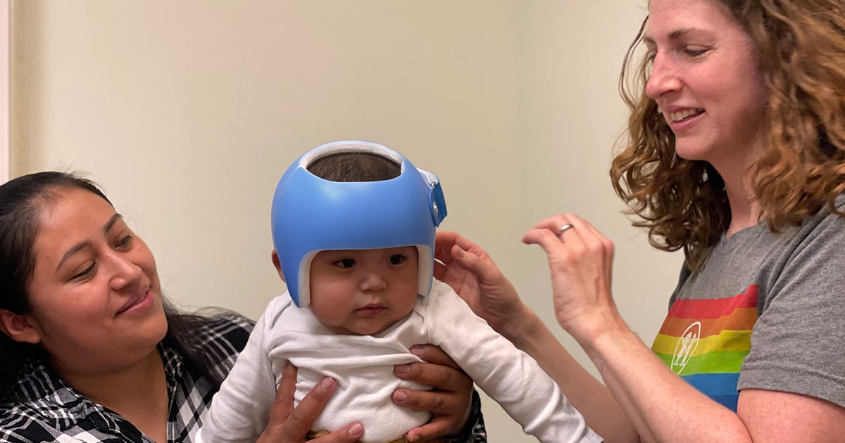 Pediatric Cranial Remolding | Children's Healthcare of Atlanta