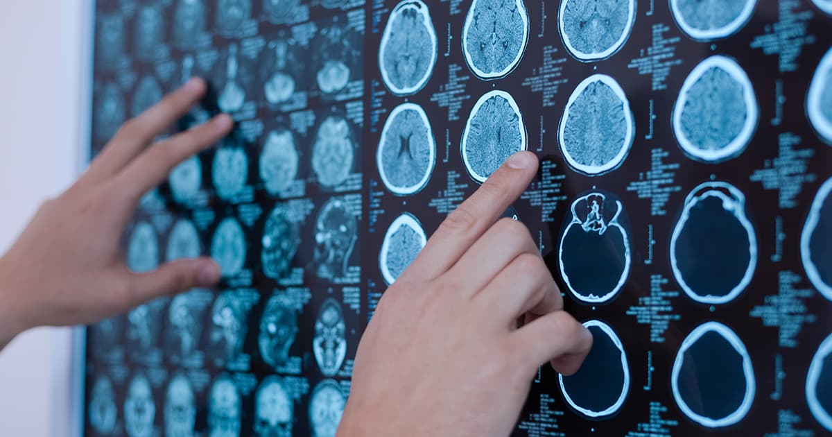 Concussion Research | Children's Healthcare of Atlanta